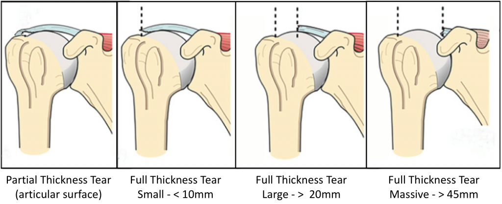 Fig 10. Full Thickness Tears - Cambridge Shoulder
