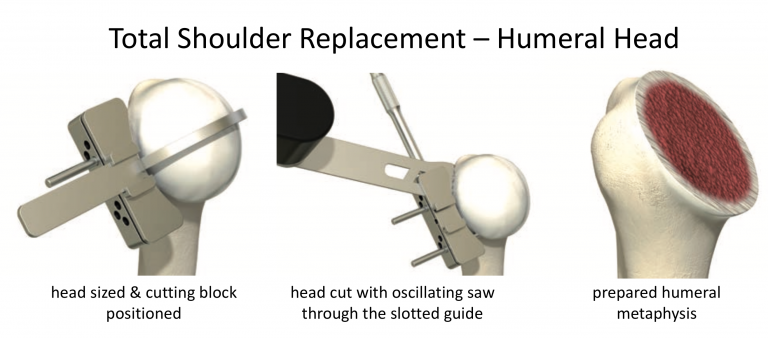 Fig 10. TSR Humeral Cut - Cambridge Shoulder