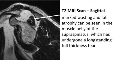 Fig 11 A. Fat atrophy - Cambridge Shoulder