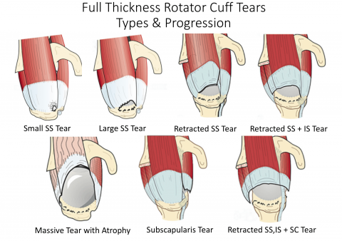 Fig 11. Types of Tears - Cambridge Shoulder