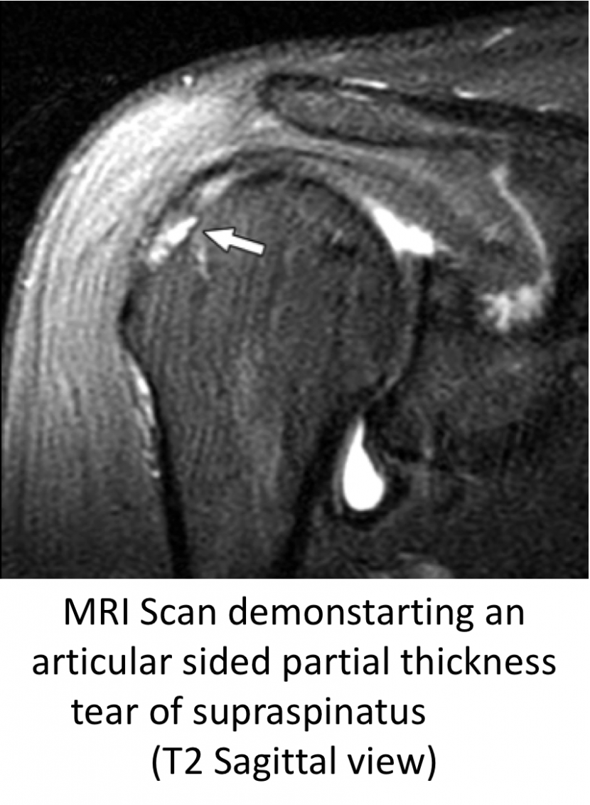 Fig 12. MRI PTT - Cambridge Shoulder