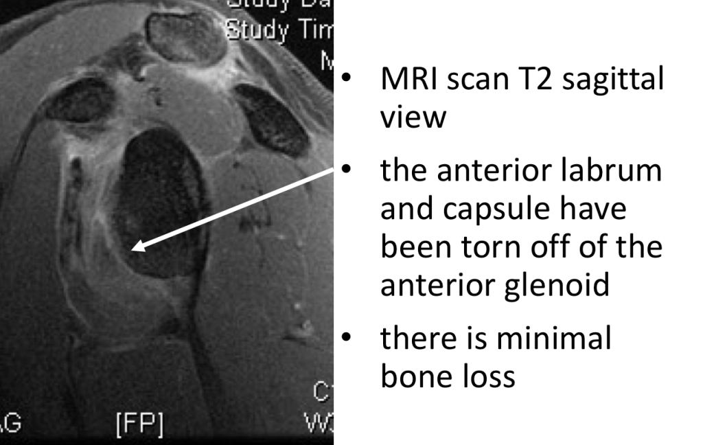 Fig 18. MRI Sag Soft-tissue Bankart - Cambridge Shoulder