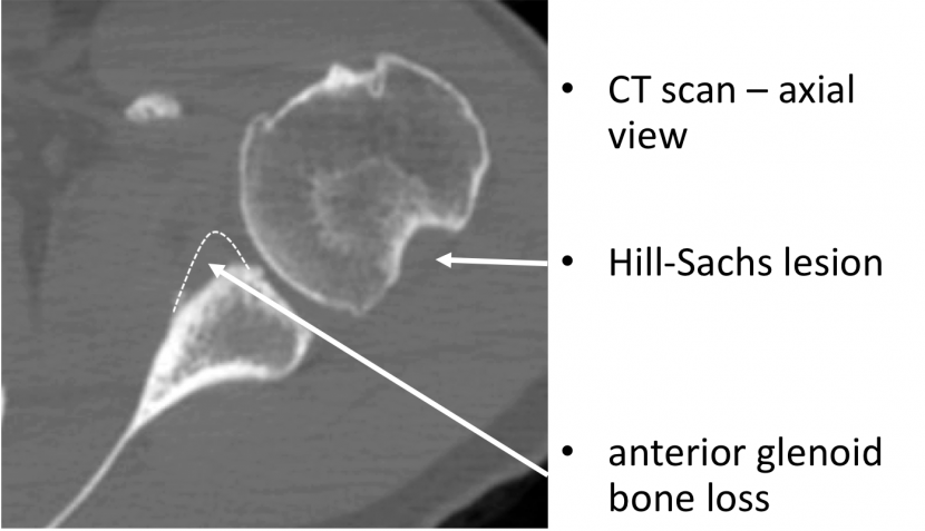 Fig 19. CT Glenoid Bone Loss - Cambridge Shoulder