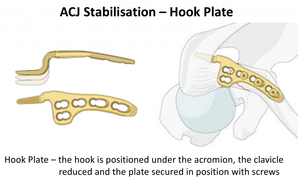 Fig 29 Hook Plates - Cambridge Shoulder