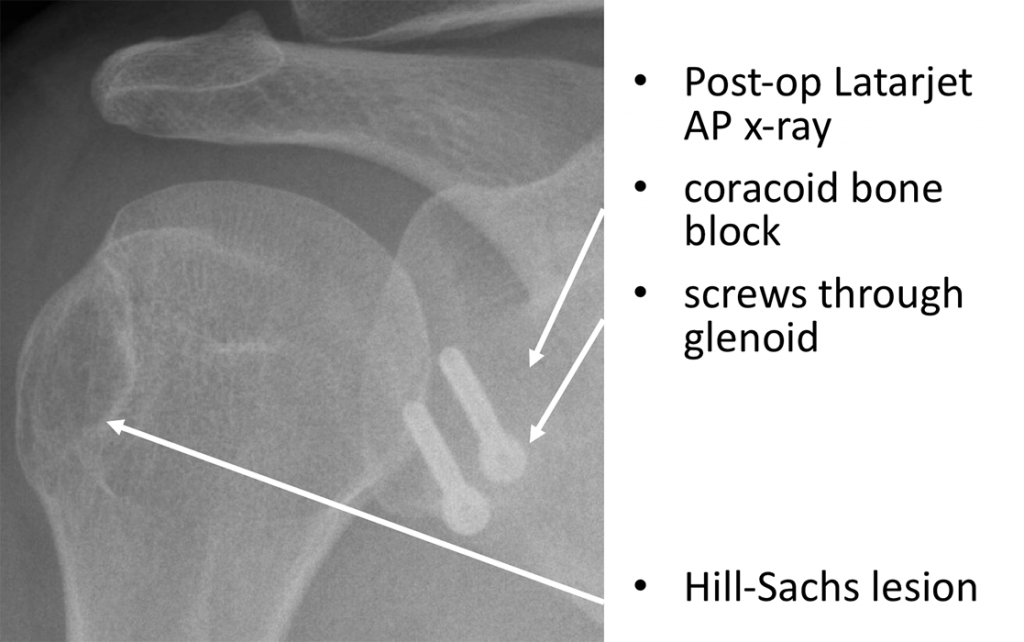 Fig 33. Lat x-ray Lat - Cambridge Shoulder