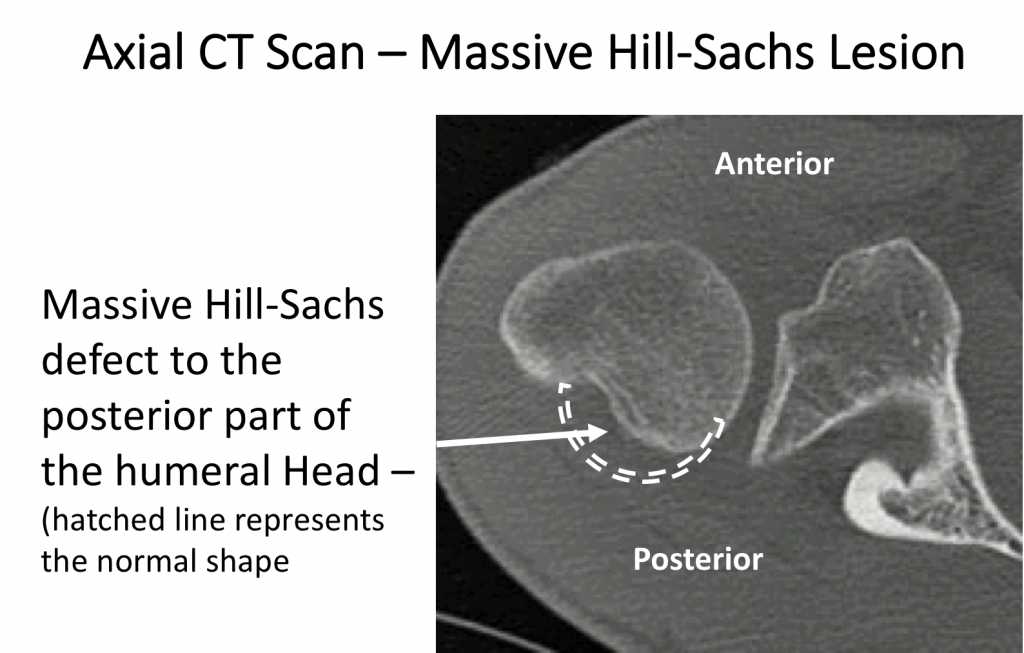 Fig 41. CT Massive H-sachs - Cambridge Shoulder