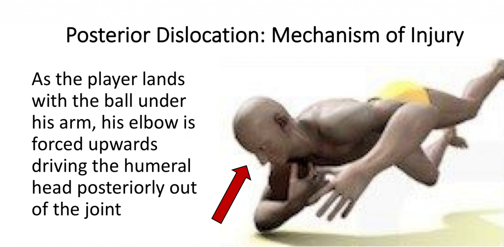 Fig 44. Post Mechanism - Cambridge Shoulder