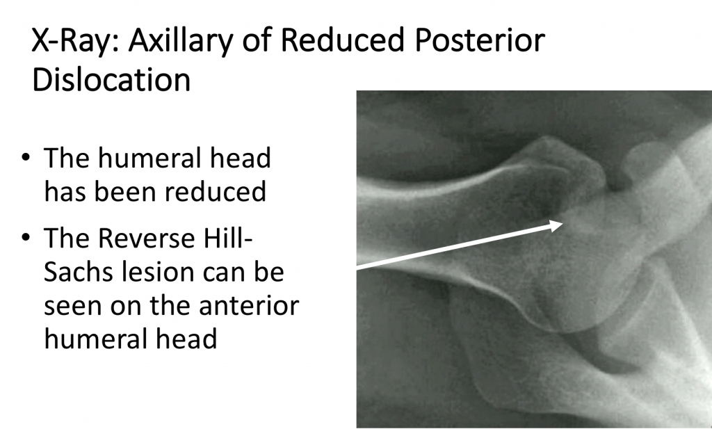 Fig 47. X-Ray of reduced rev H-Sachs – Cambridge Shoulder