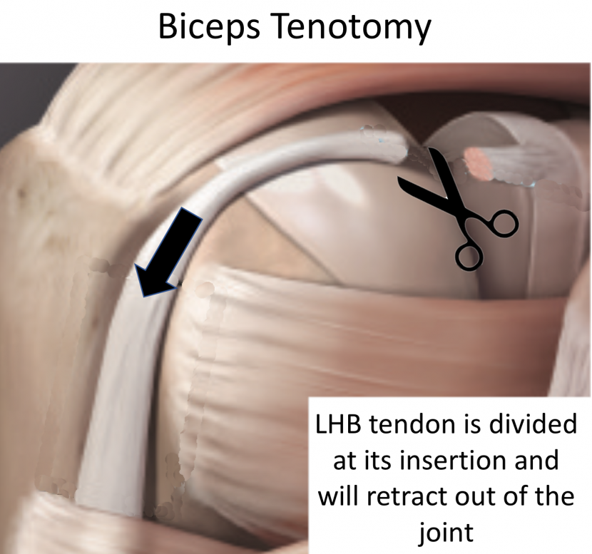 Fig 8. Biceps Tenotomy - Cambridge Shoulder