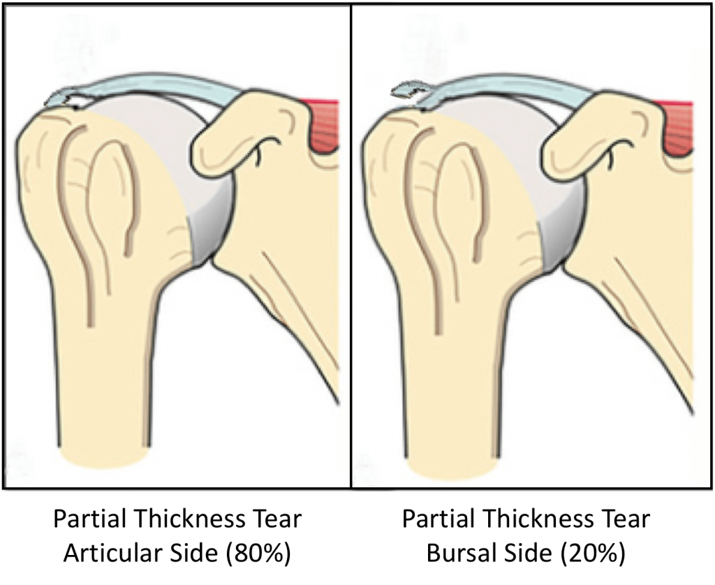Fig 9. Partial Thickness Tear - Cambridge Shoulder