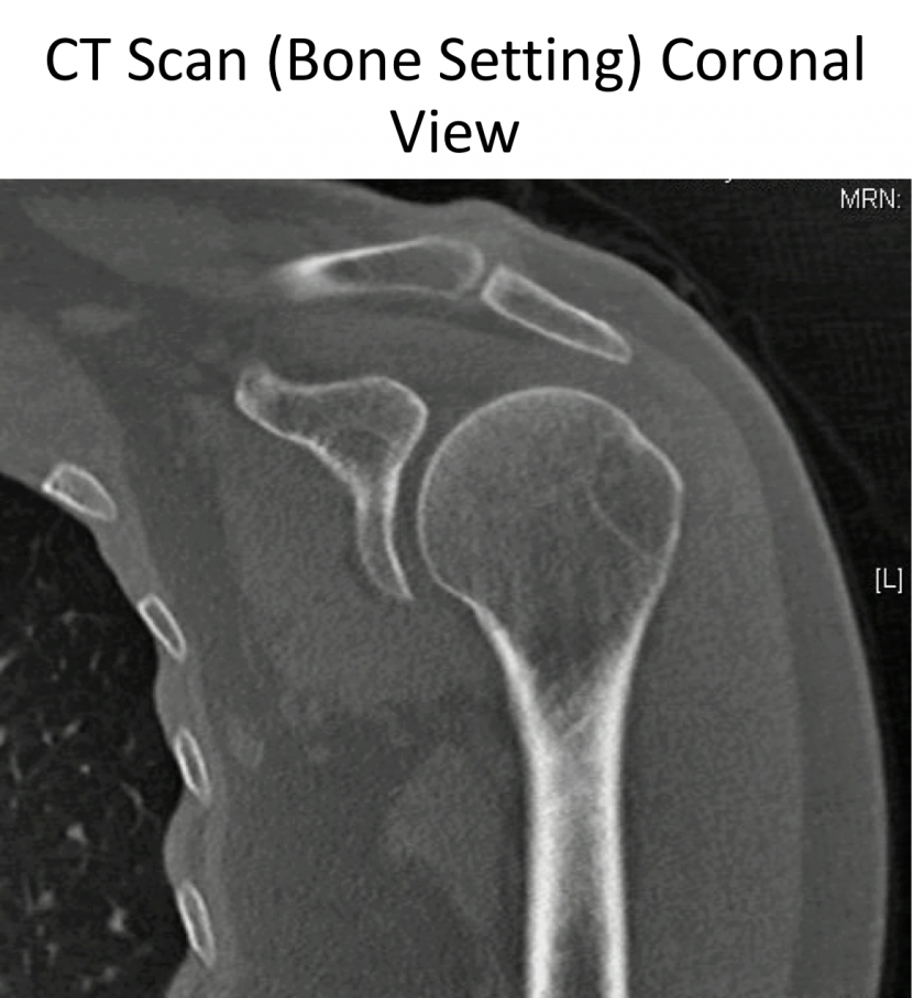 Fig 11. CT Coronal - Cambridge Shoulder