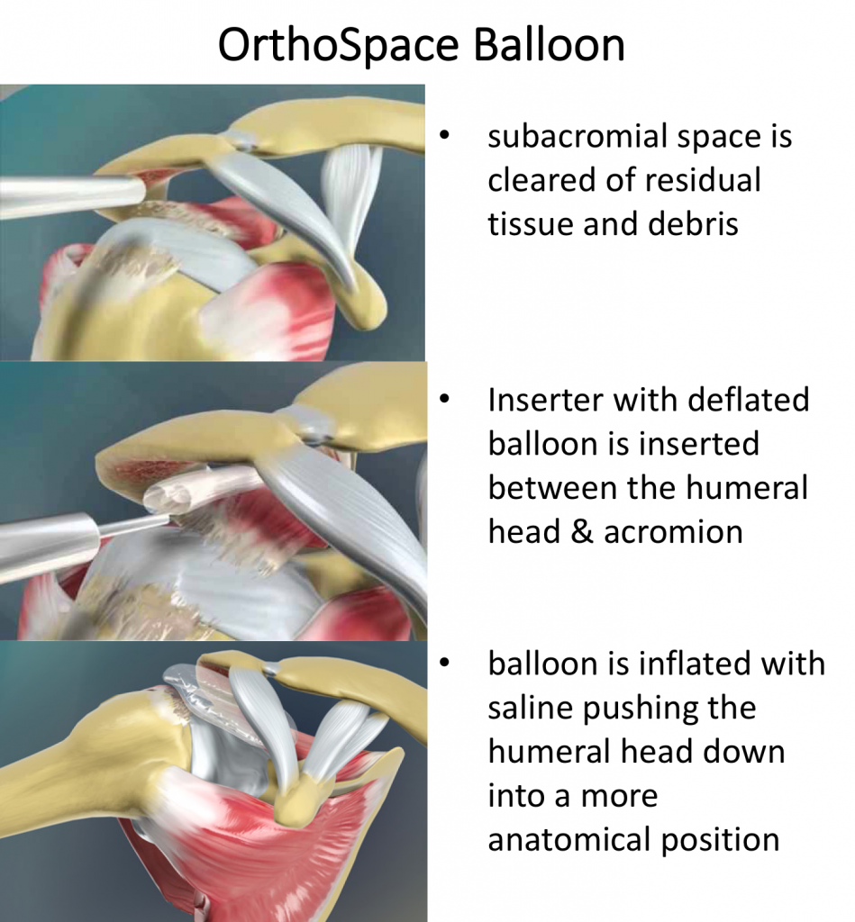 Fig 26. OrthoSpace – Cambridge Shoulder