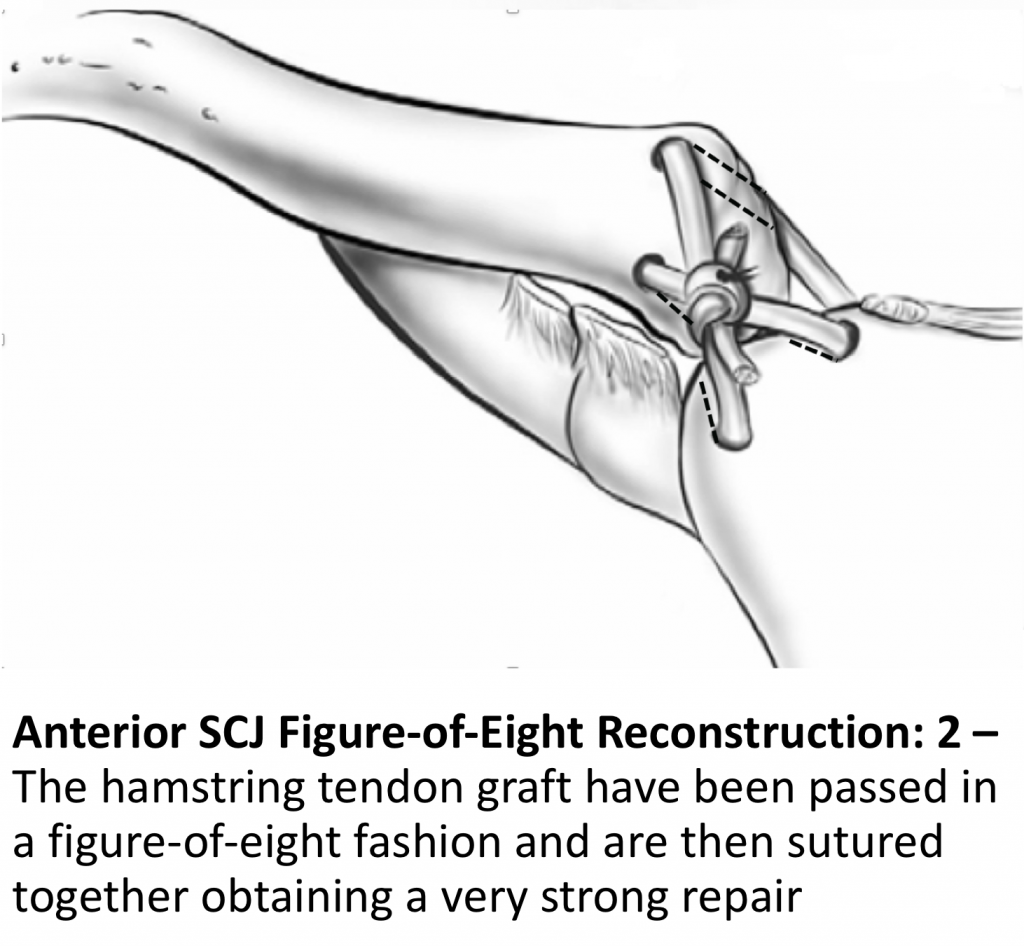 Fig 37.figure-of-8 2 – Cambridge Shoulder