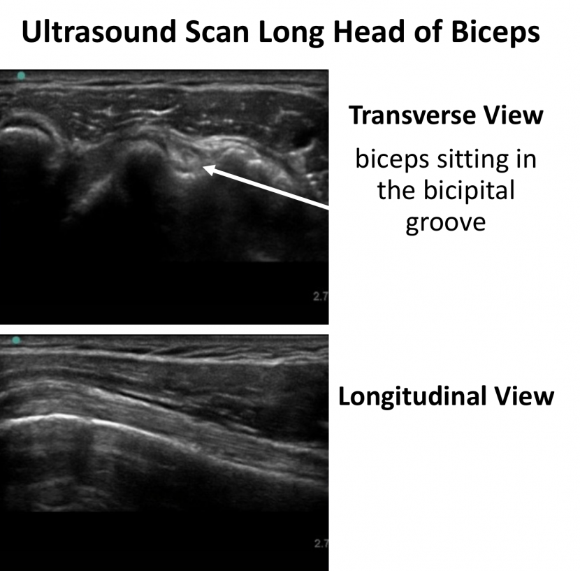 Fig 5. USS LHB - Cambridge Shoulder